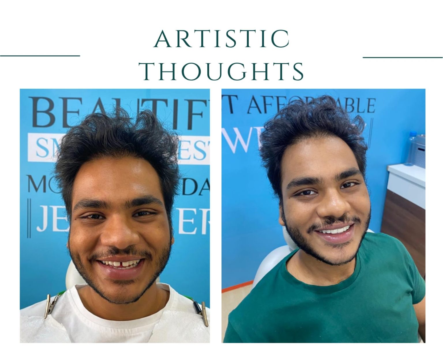 Teeth Alignment – Synergy Dental Clinic